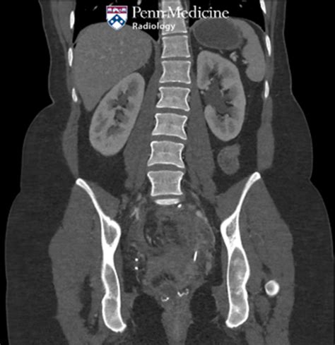 39 Year Old Woman With Abdominal Pain Post Proctocolectomy Myauntminnie