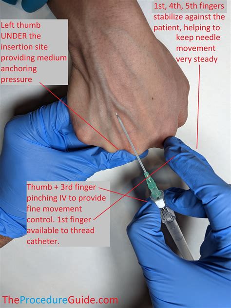 Peripheral Intravenous Access Iv Technique And Overview The