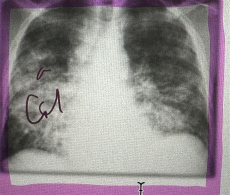 Sys Path Lungs Flashcards Quizlet