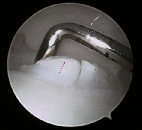 Ankle Arthroscopy With Microfracture For Osteochondral Defects Of The