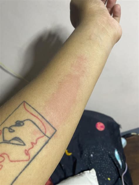 Are These Signs Of Hives And Urticaria Rurticaria