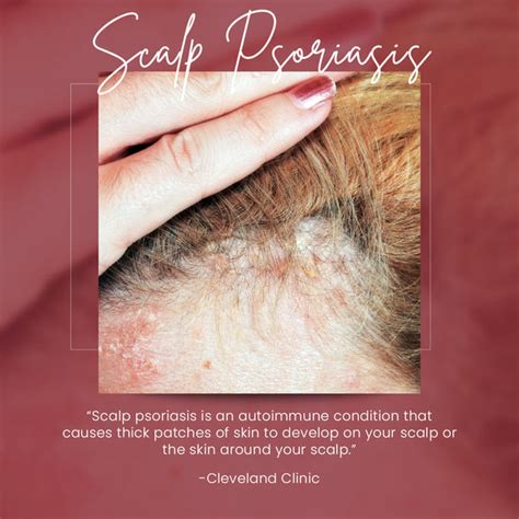 What Is Plaque Psoriasis On Your Scalp