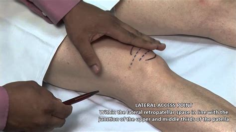 Knee Arthrocentesis Landmarks