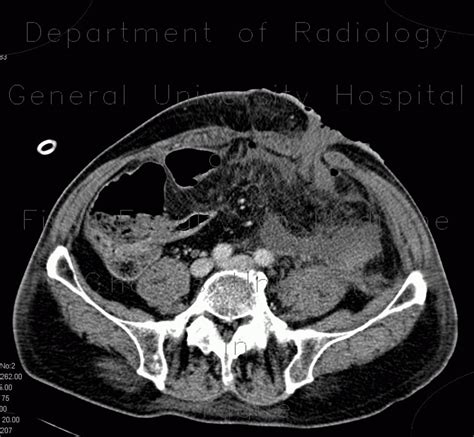 Colostomy Enema Radiology At James Vance Blog