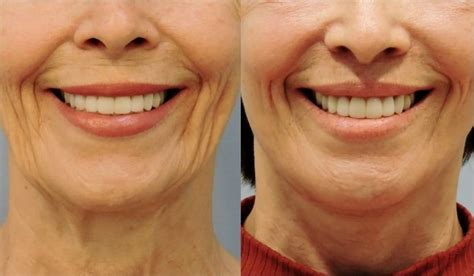 Lifting Labial O Segredo Para Uma Boca Mais Bonita