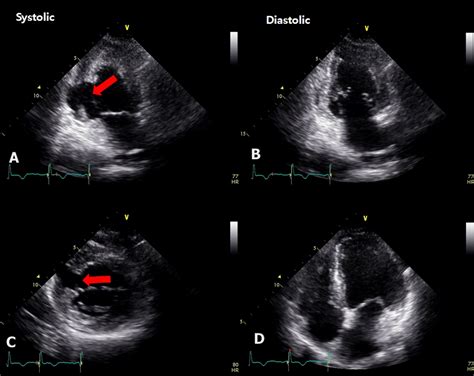 Fatal Left Ventricular Free Wall Rupture Following Acute Myocardial