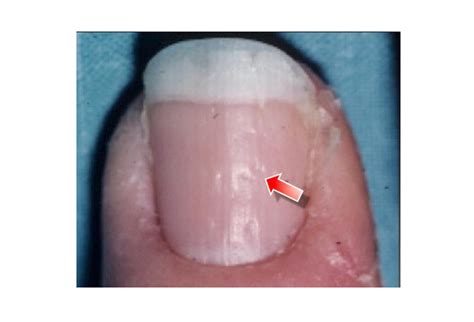 Fingernail And Toenail Abnormalities Nail The Diagnosis