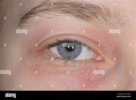 Eyelid Eczema In A 16 Year Old Female Patient Also Known As Known As