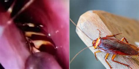 Watch Doctors Pull A Living Cockroach From A Womans Skull Mens Health