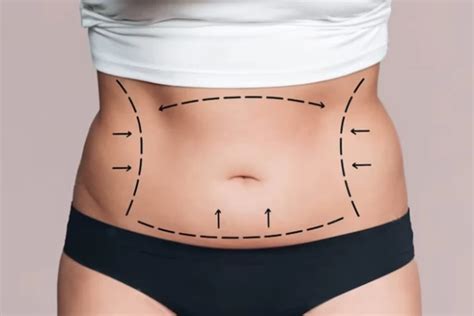 What To Expect From A Tummy Tuck 20 Years Later