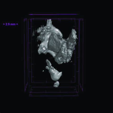 Micro Ct Image Of A Fibrocalcific Plaque Sample In Which The