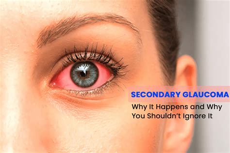 Secondary Glaucoma Why It Happens And Why You Shouldnt Ignore It