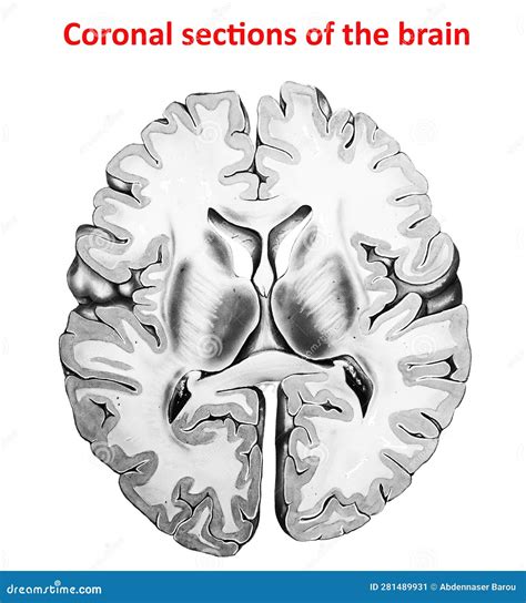 Coronal Section Of The Brain Stock Illustration Illustration Of Together Axons 281489931