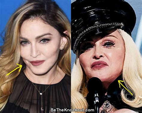 Madonna Plastic Surgery Comparison Photos