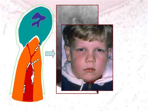 Apical Periodontitis Tooth Inflammationppt