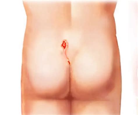 Advancements In Pilonidal Sinus Surgery Emerging Techniques And Technologies Dr Dhruv Kundra