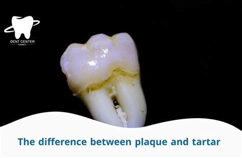 The Difference Between Plaque And Tartar Dentcenterturkey