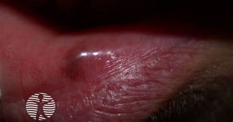 Labial Melanotic Macule Image