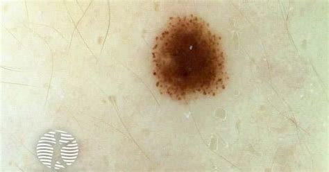 Dermoscopy Complex Pattern Peripheral Globules Naevus Image