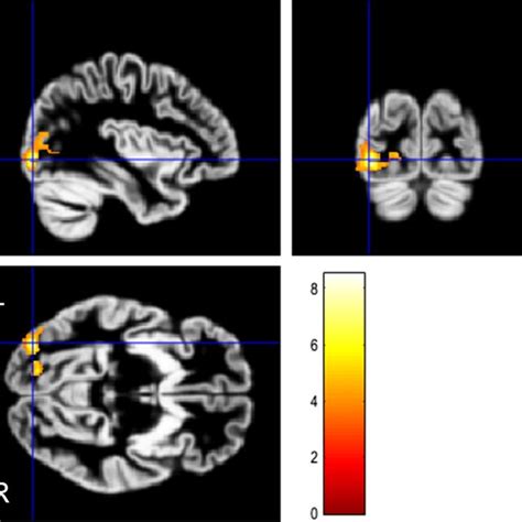 Vbm Analysis With Small Volume Correction Restricted To The Occipital