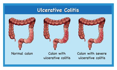 What Is Ulcertive Colitis। Causes Of Uc And Sign And Symptoms Diagnosis And Treatment