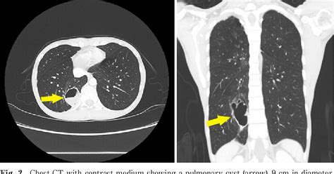 Figure 1 From Surgical Resection Of An Infectious Pulmonary Cyst In A Patient With Anhidrotic
