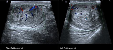 Systematic Review Of Bilateral Epididymal Leiomyomas The Annals Of