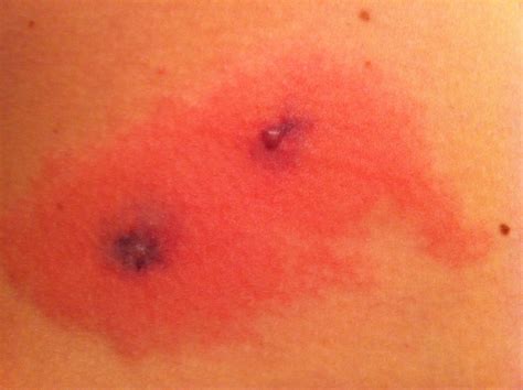 The Good The Bad And The Ugly Fiddleback Spider Bites Day 1