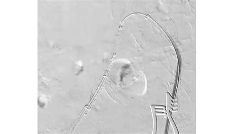 Coding Complex Vascular Cases Aapc Knowledge Center