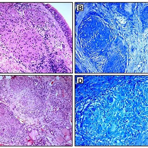 Histopathological Examination Ab Non Necrotizing Granulomas In