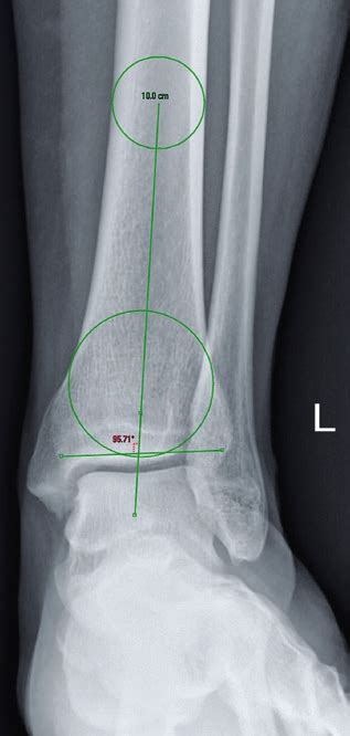 Distal Tibial Articular Angle Download Scientific Diagram