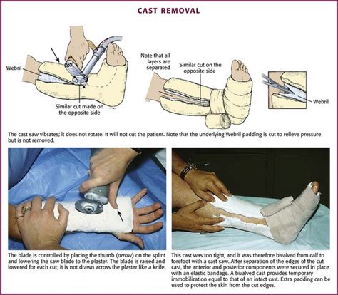 Posterior Plaster Splint Elbow