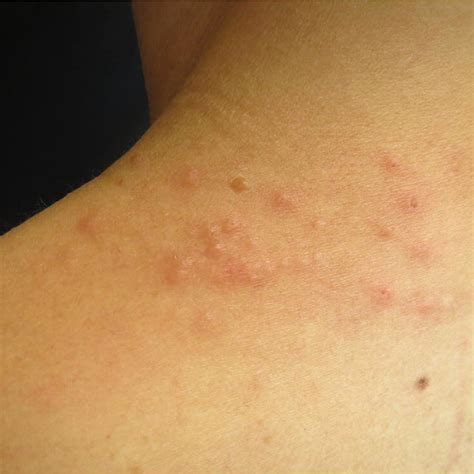 Multiple Pinpoint Flesh Colored Papules On Sun Exposed Skin Of A Download Scientific Diagram Multiple Pinpoint Flesh Colored Papules On Sun Exposed Skin Of A Download Scientific Diagram