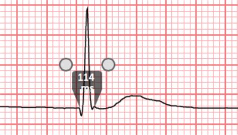 Teaching Medicine Tutorial Analyze The Waveforms