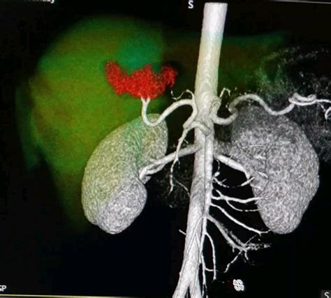 Mahmoud Elhelaly On Linkedin Ct Liver Triphasic Show Lesion In