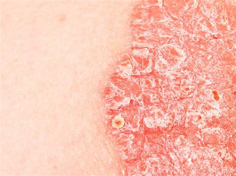 Eye Manifestations In Psoriasis