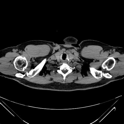 Gravity Dependent Atelectasis Image