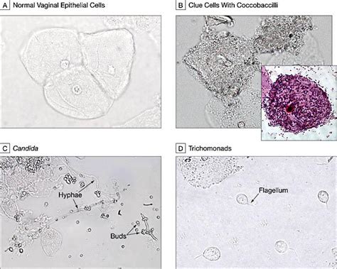 Vaginal Candidiasis Microscopy