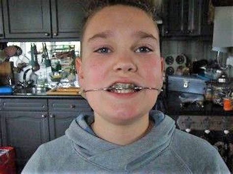 Pin Di Bruce Nicolosi Su Adult Braces