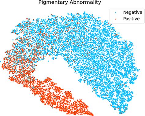 Automation Of Macular Degeneration Classification In Areds Opth