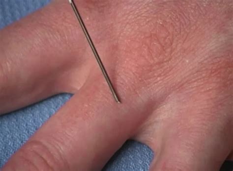 Nerve Block Examples At Enrique Ivy Blog
