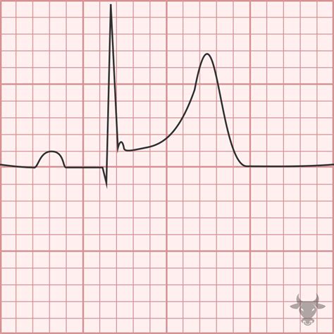 Early Repolarization Ecg Stampede