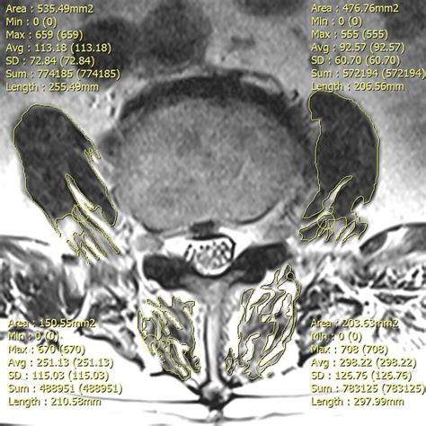 Measurement Of Cross Sectional Area Csa Of Bilateral Psoas Ps And Download Scientific