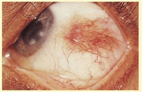 Phlyctenular Keratoconjunctivitis Ento Key