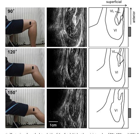 Figure 1 From The Highest Antagonistic Coactivation Of The Vastus Intermedius Muscle Among