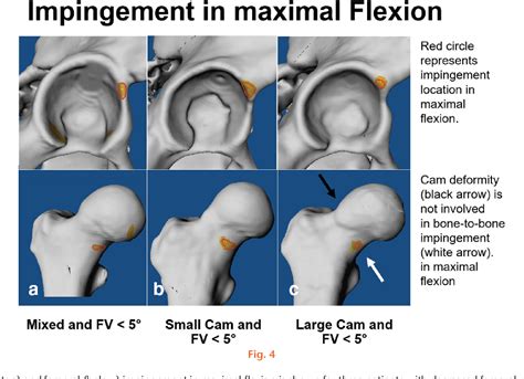 Figure 4 From Femoral Impingement In Maximal Hip Flexion Is Anterior