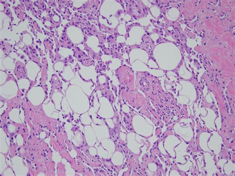 Angiosarcoma Histology