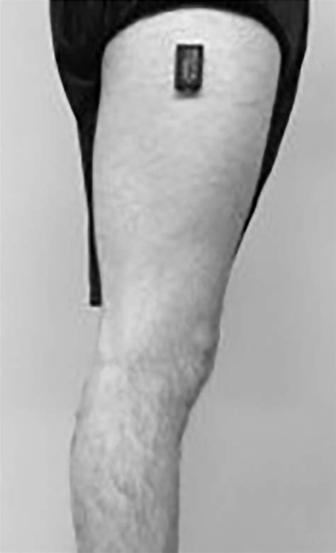 Use Of Accelerometer Based Activity Monitoring In Orthopaedics Benefits Impact And Practical