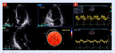 Figure 3 From Left Atrium Remodeling After Catheter Ablation Of Atrial