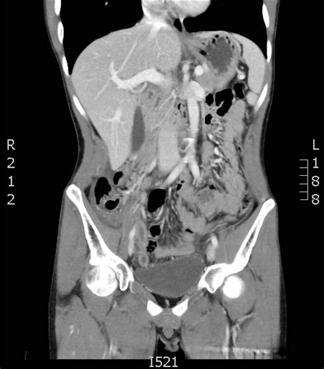 Computed Tomography Diagnosis Of Appendicitis Jetem